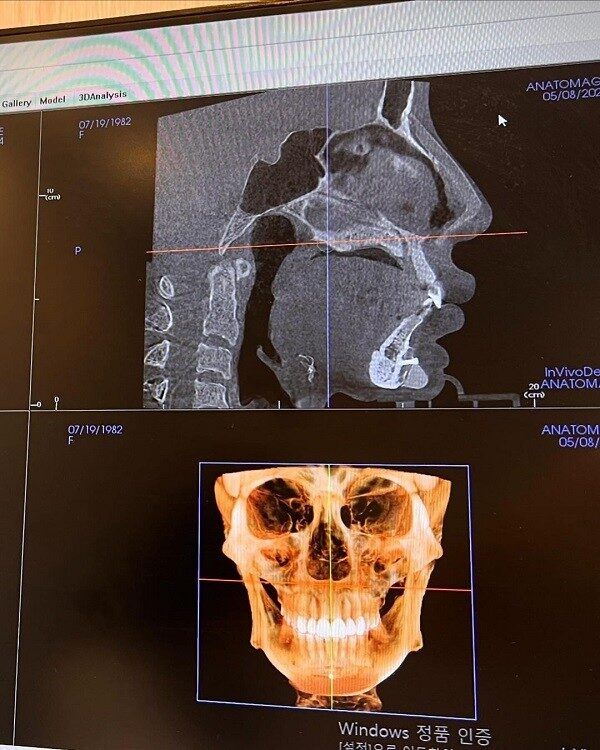 Popular Model's Shocking Face X-Rays Expose Horrors Of Plastic Surgery - Koreaboo