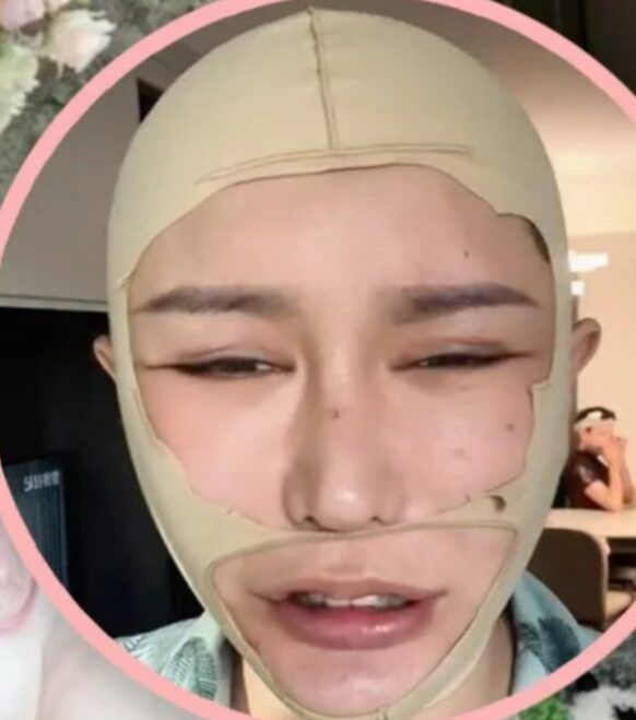 Transgender Influencer's Botched Feminization Plastic Surgery Sparks ...