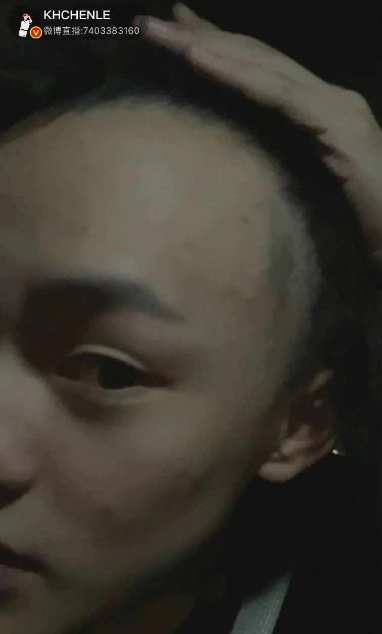 NCT's Chenle Raises Concerns After Showing His Hair Loss - Koreaboo